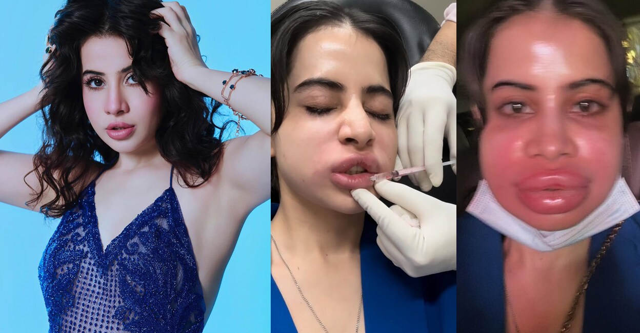 ചുണ്ടുകള്‍ സുന്ദരമാക്കാന്‍ ലിപ് ഫില്ലര്‍; നീരു വച്ച് വീര്‍ത്ത് രൂപം മാറിയ ഉര്‍ഫി